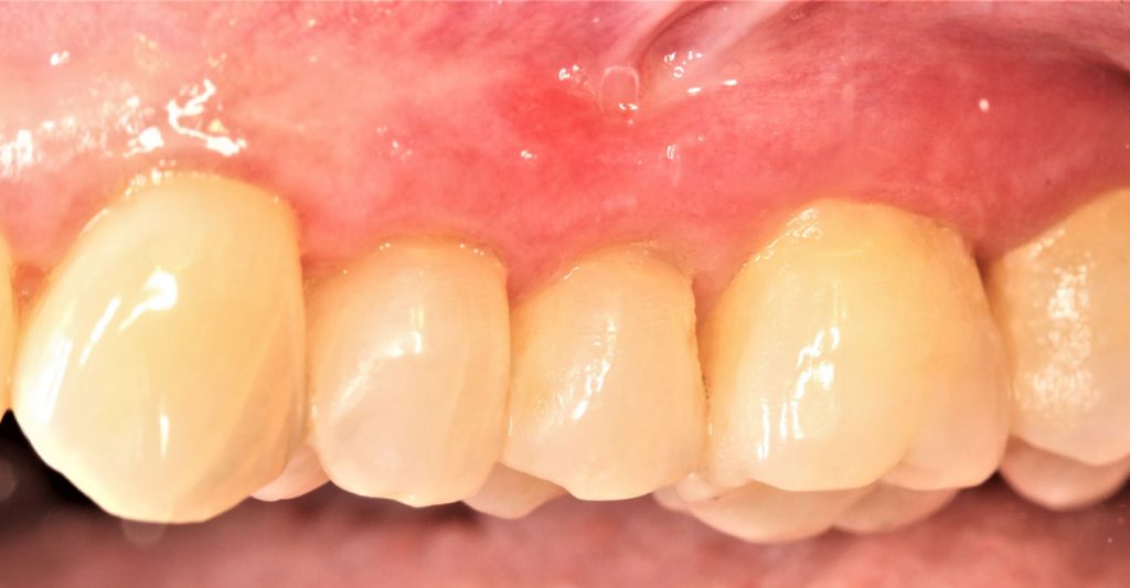 Lime Periodontics | Periodontics - Peyman Shahidi